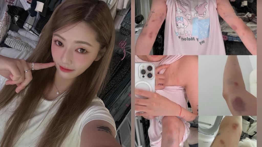 台灣46萬YTR「拒絕陪睡」遭南韓人當街暴打！全身瘀青、骨折傷勢照曝光｜四季線上4gTV